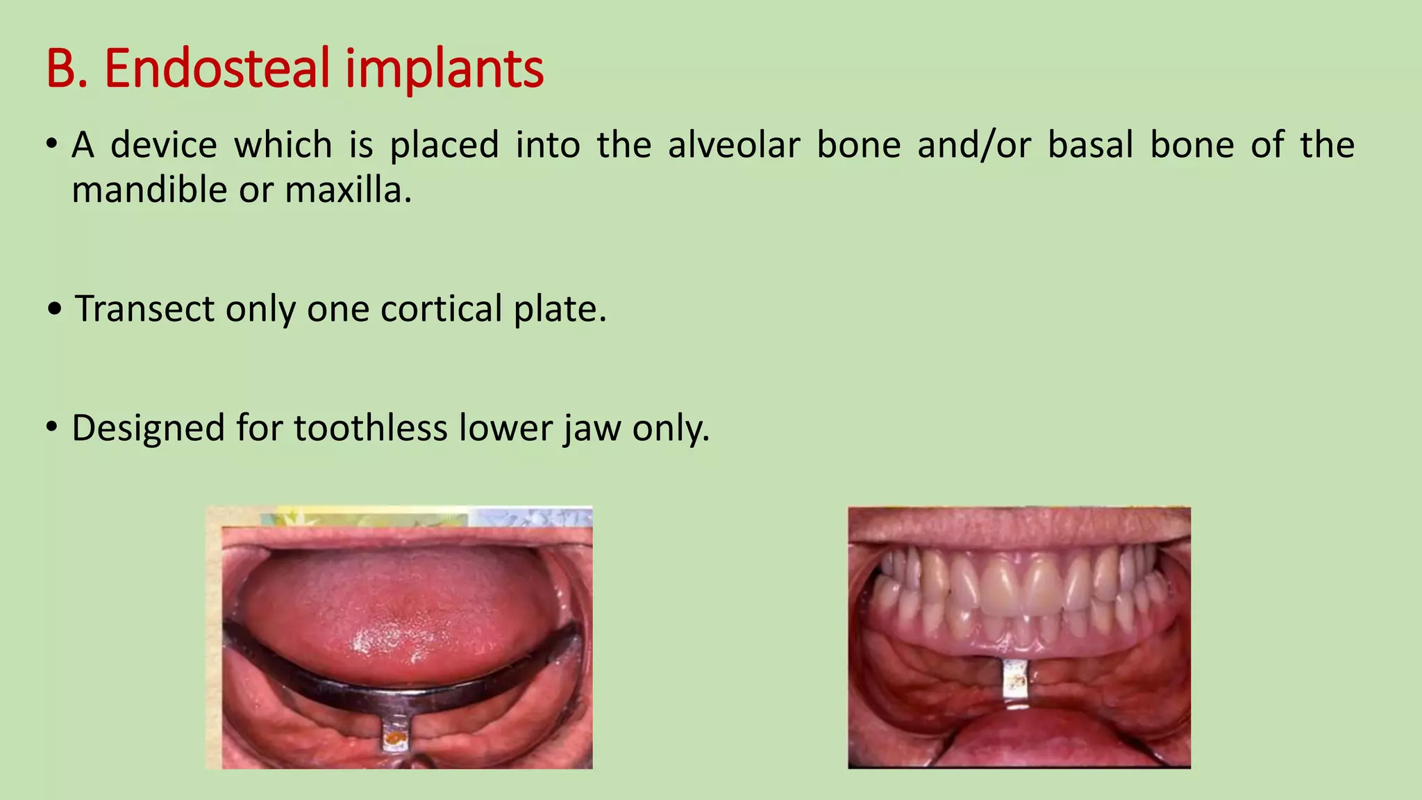 Dental Implant Designs | PPTX