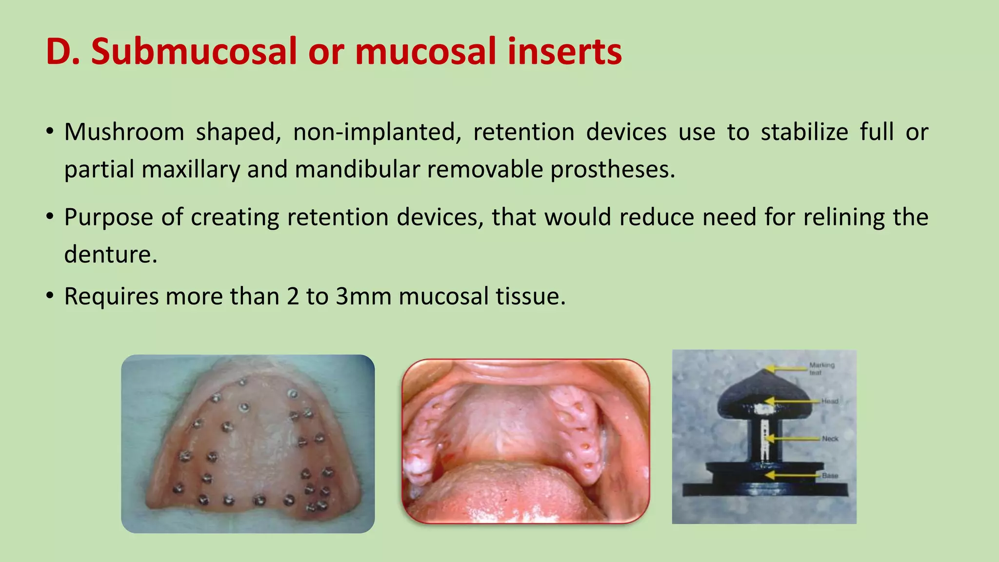 Dental Implant Designs | PPTX