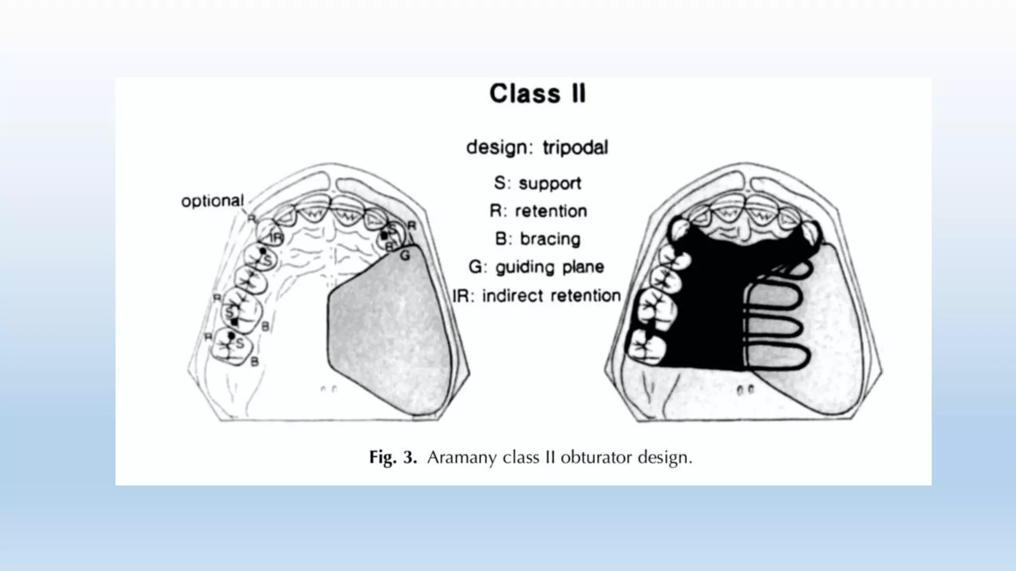 OBTURATORS FOR ACQUIRED MAXILLARY DEFECTS | PPTX