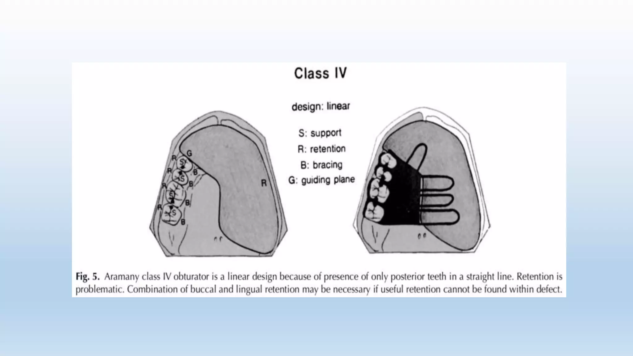 OBTURATORS FOR ACQUIRED MAXILLARY DEFECTS | PPTX