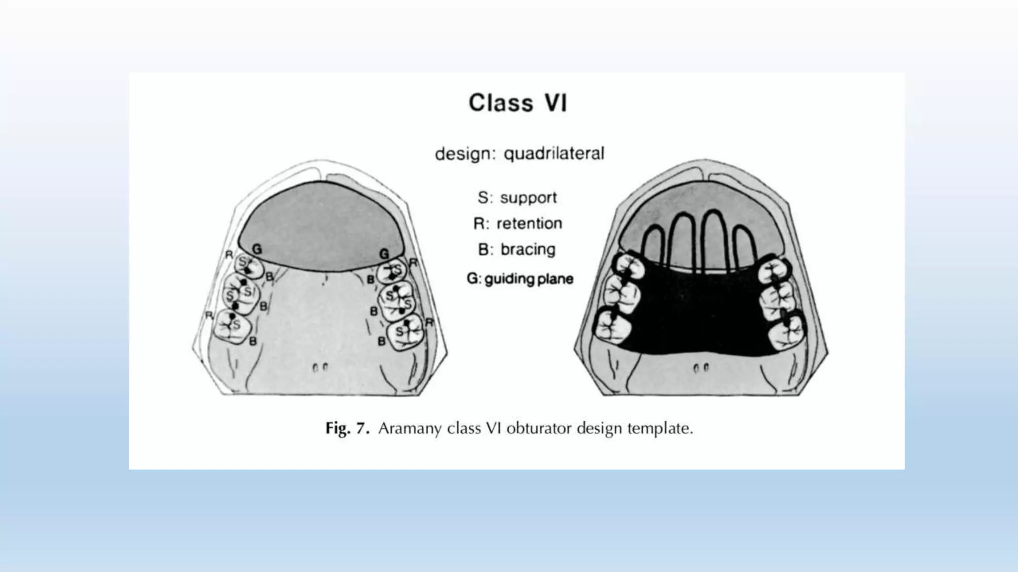OBTURATORS FOR ACQUIRED MAXILLARY DEFECTS | PPTX