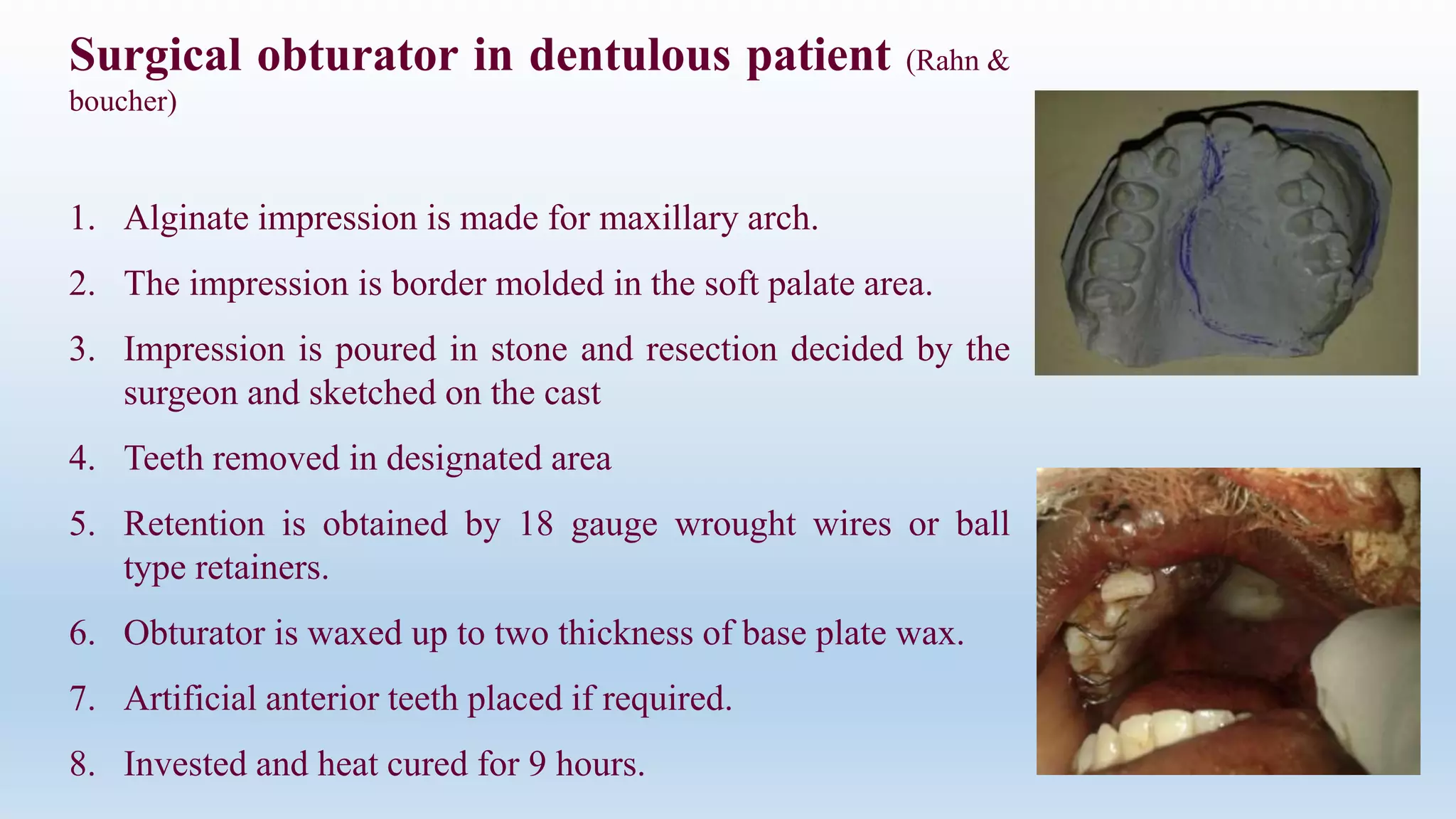 OBTURATORS FOR ACQUIRED MAXILLARY DEFECTS | PPTX