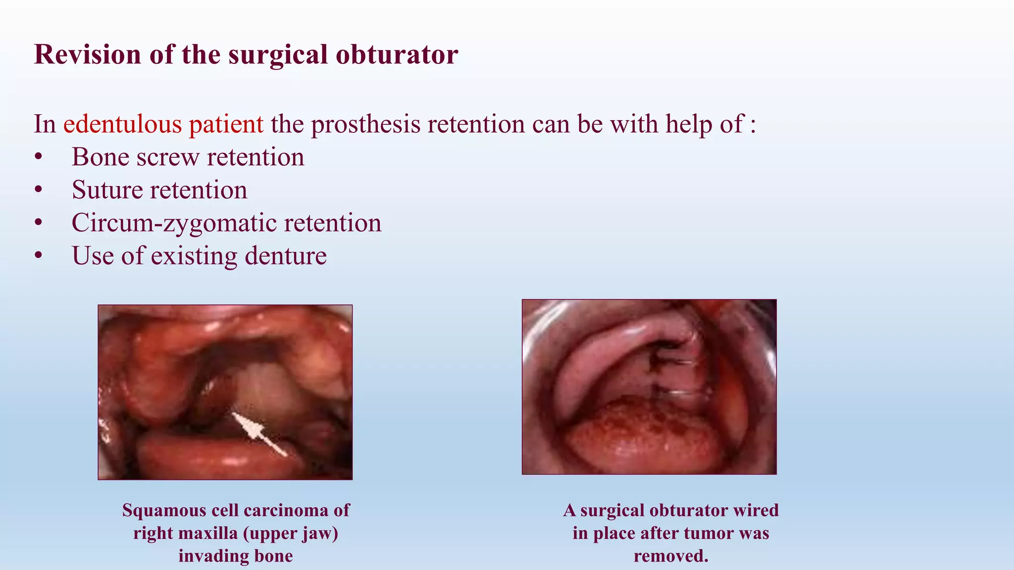 OBTURATORS FOR ACQUIRED MAXILLARY DEFECTS | PPTX