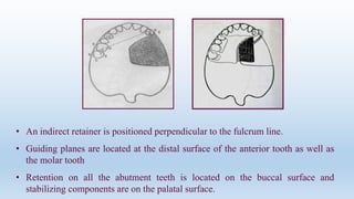 OBTURATORS FOR ACQUIRED MAXILLARY DEFECTS | PPTX