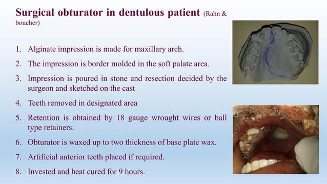 OBTURATORS FOR ACQUIRED MAXILLARY DEFECTS | PPT