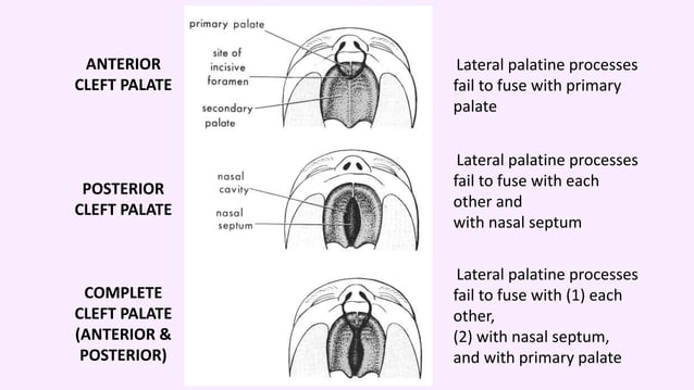 CLEFT LIP AND PALATE | PPTX