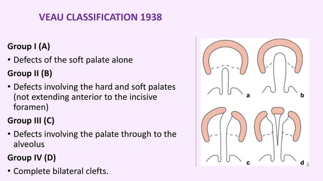CLEFT LIP AND PALATE | PPTX