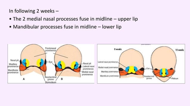 CLEFT LIP AND PALATE | PPTX