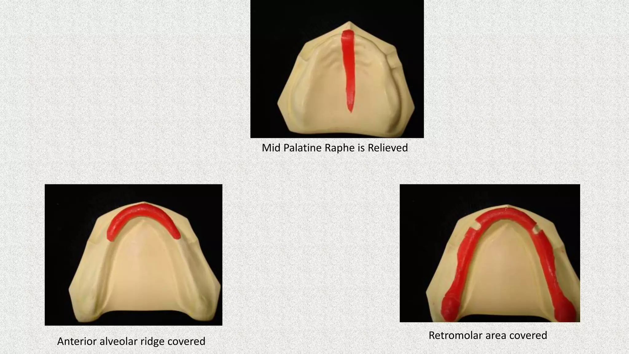 Impressions in complete denture | PPTX
