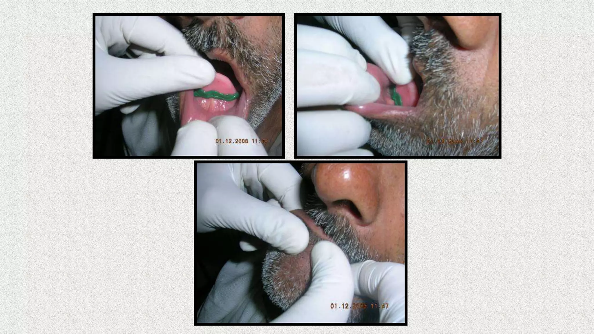 Impressions in complete denture | PPTX