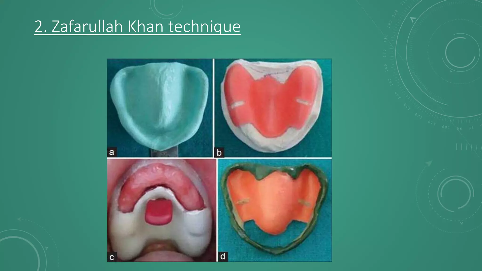 IMPRESSION TECHNIQUES IN COMPROMISED COMPLETE DENTURE SITUATIONS | PPTX