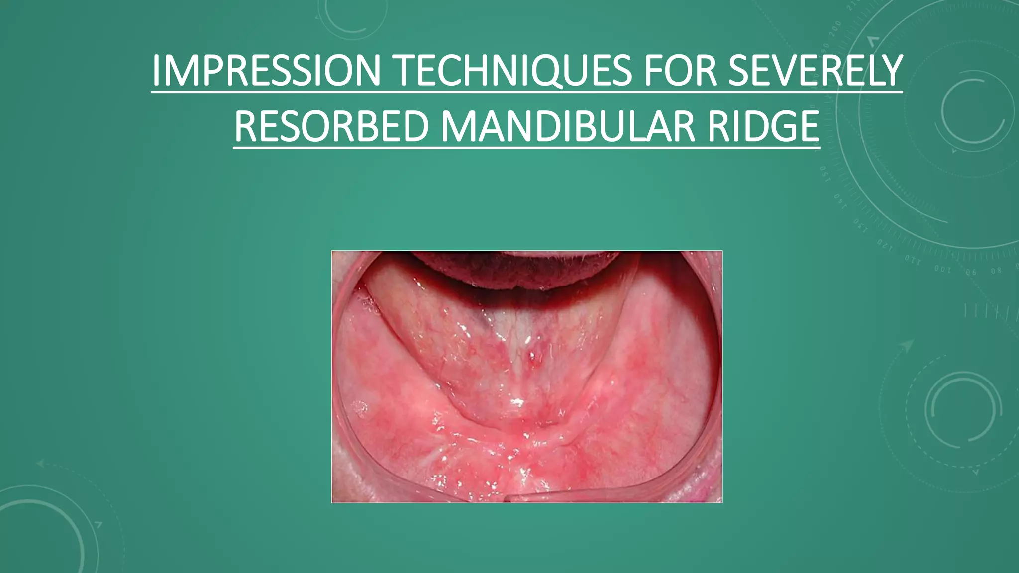 IMPRESSION TECHNIQUES IN COMPROMISED COMPLETE DENTURE SITUATIONS | PPTX