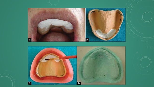 IMPRESSION TECHNIQUES IN COMPROMISED COMPLETE DENTURE SITUATIONS | PPTX ...