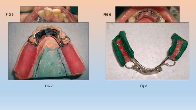 impression techniques in Removable Partial Denture | PPTX | Oral care | Personal Care