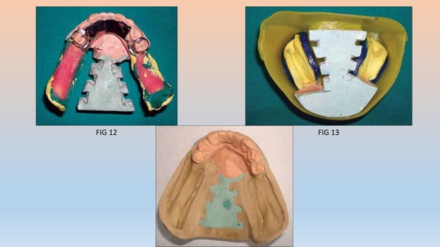 impression techniques in Removable Partial Denture | PPTX | Oral care ...
