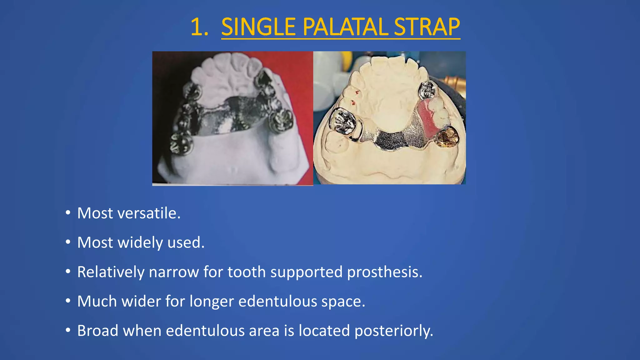 MAXILLARY MAJOR CONNECTORS | PPT