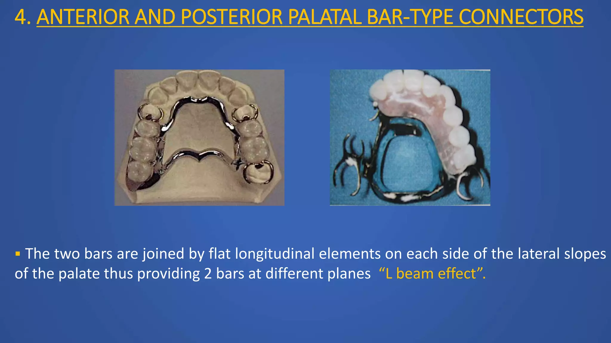 MAXILLARY MAJOR CONNECTORS | PPT