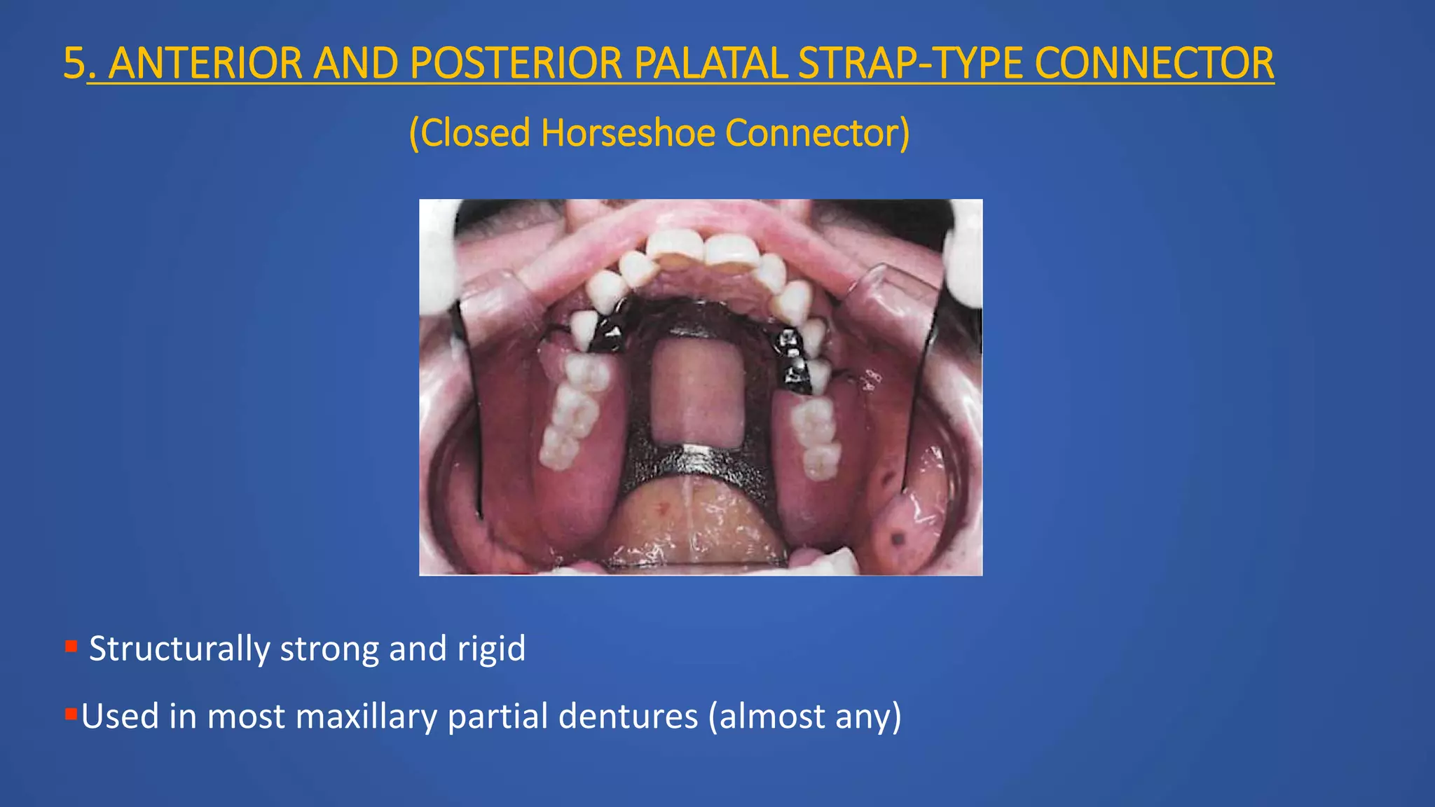 MAXILLARY MAJOR CONNECTORS | PPT