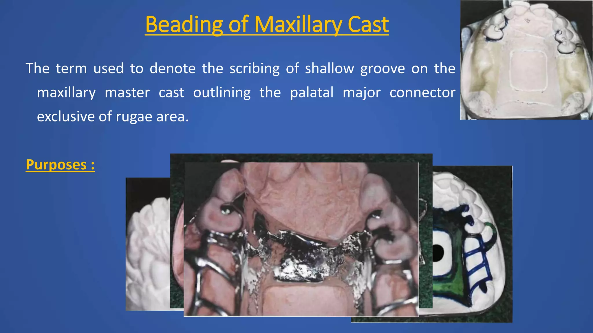 MAXILLARY MAJOR CONNECTORS | PPT