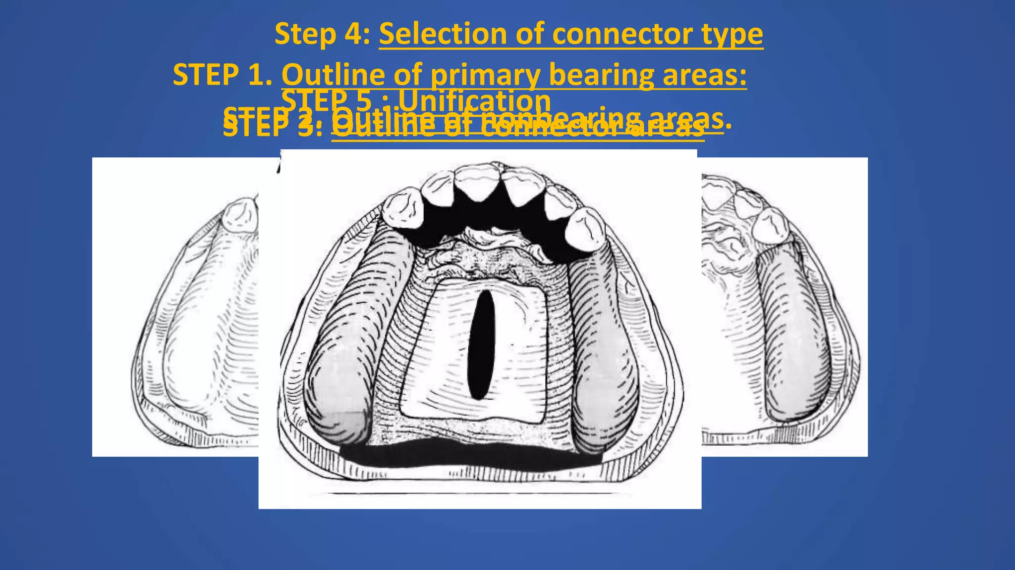 MAXILLARY MAJOR CONNECTORS | PPT