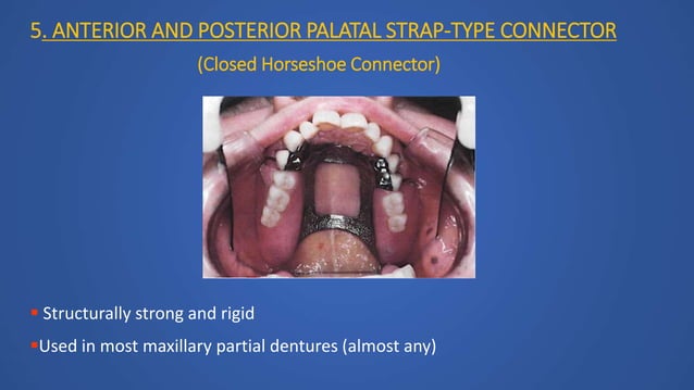 MAXILLARY MAJOR CONNECTORS | PPT