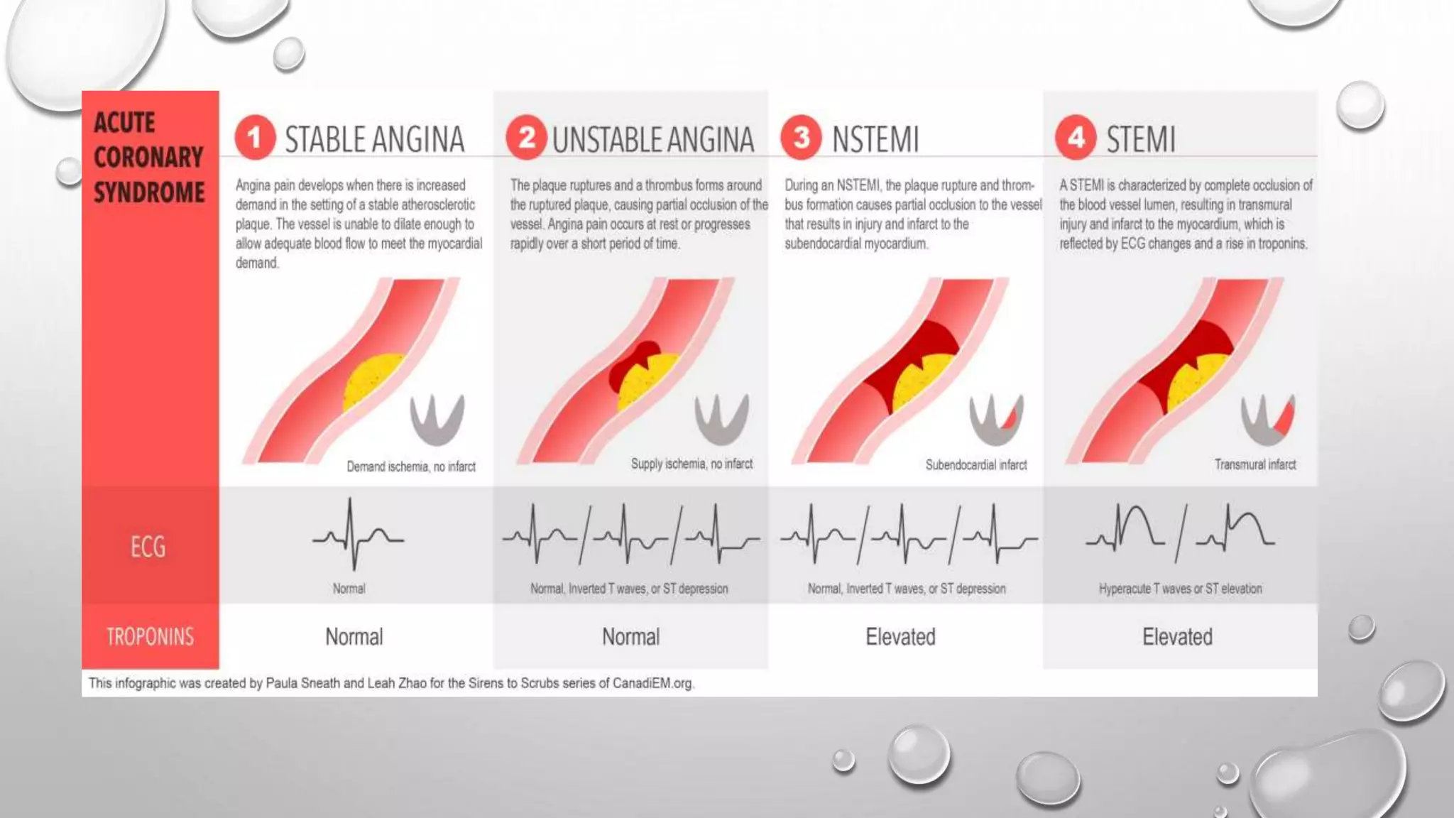 Richa singh ecg in ischemic heart disease | PPT