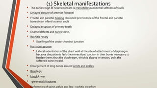 Ricket and osteomalacia | PPTX