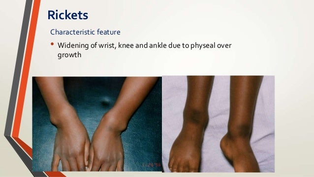 Ricket and osteomalacia