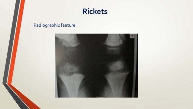 Ricket and osteomalacia