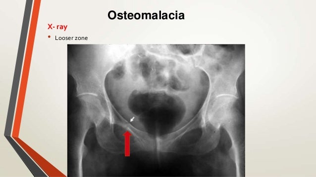 Ricket and osteomalacia