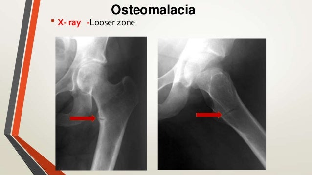 Ricket and osteomalacia