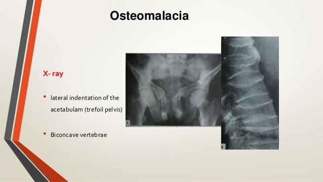 Ricket and osteomalacia