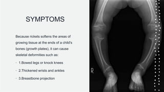 Rickets-1.pptx........................... | PPTX