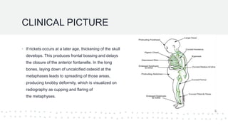 Rickets-1.pptx........................... | PPTX