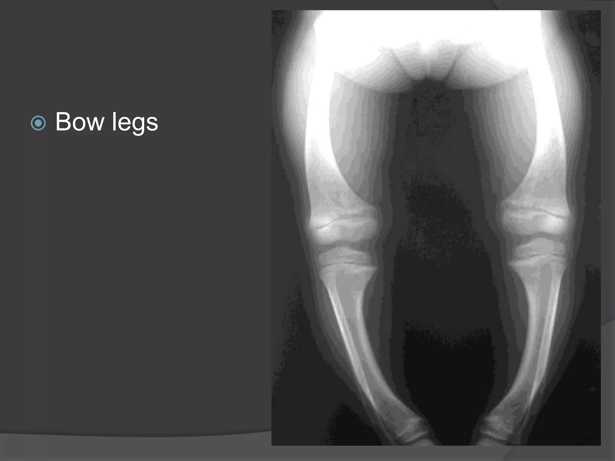 Rickets | PPTX