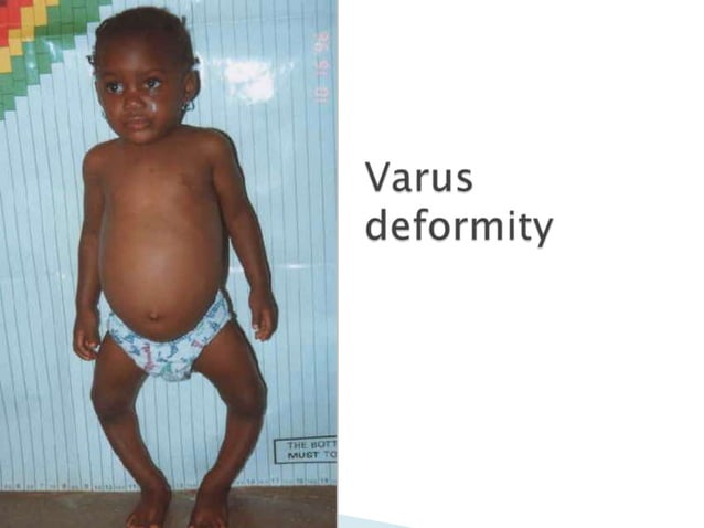 Rickets | PPTX | Bone and Joint Conditions | Diseases and Conditions