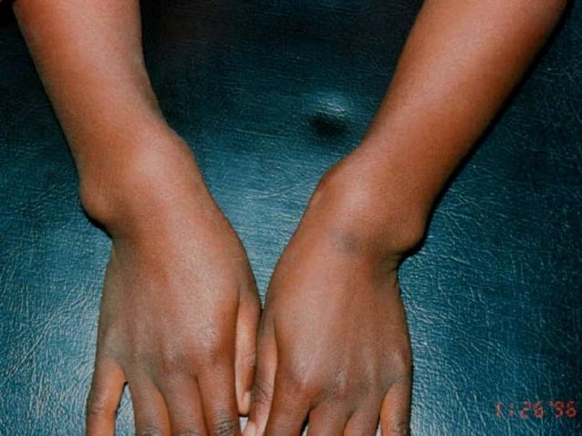 Rickets | PPTX | Bone and Joint Conditions | Diseases and Conditions