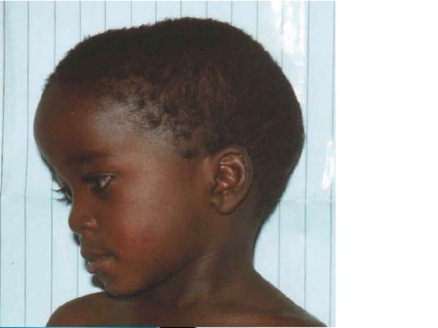 Rickets | PPTX | Bone and Joint Conditions | Diseases and Conditions