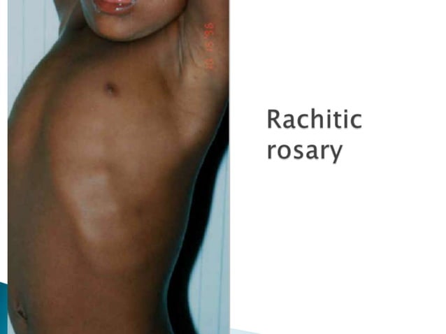 Rickets | PPTX | Bone and Joint Conditions | Diseases and Conditions