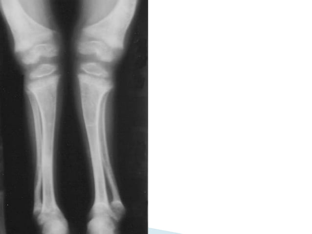 Rickets | PPTX | Bone and Joint Conditions | Diseases and Conditions