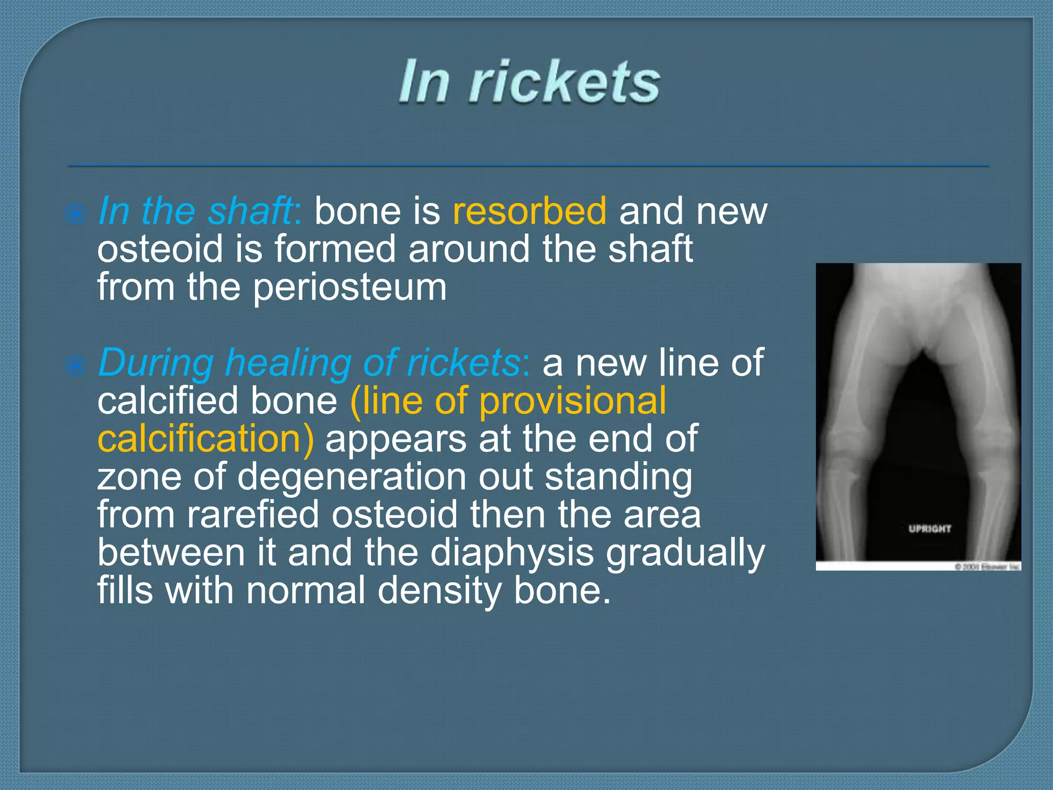 Rickets lecture | PPTX