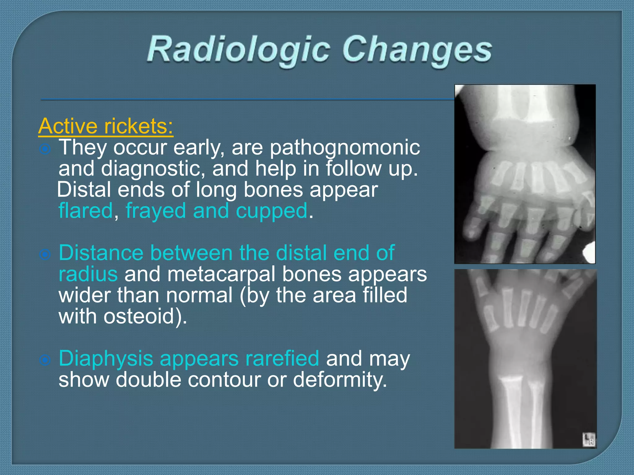Rickets lecture | PPTX