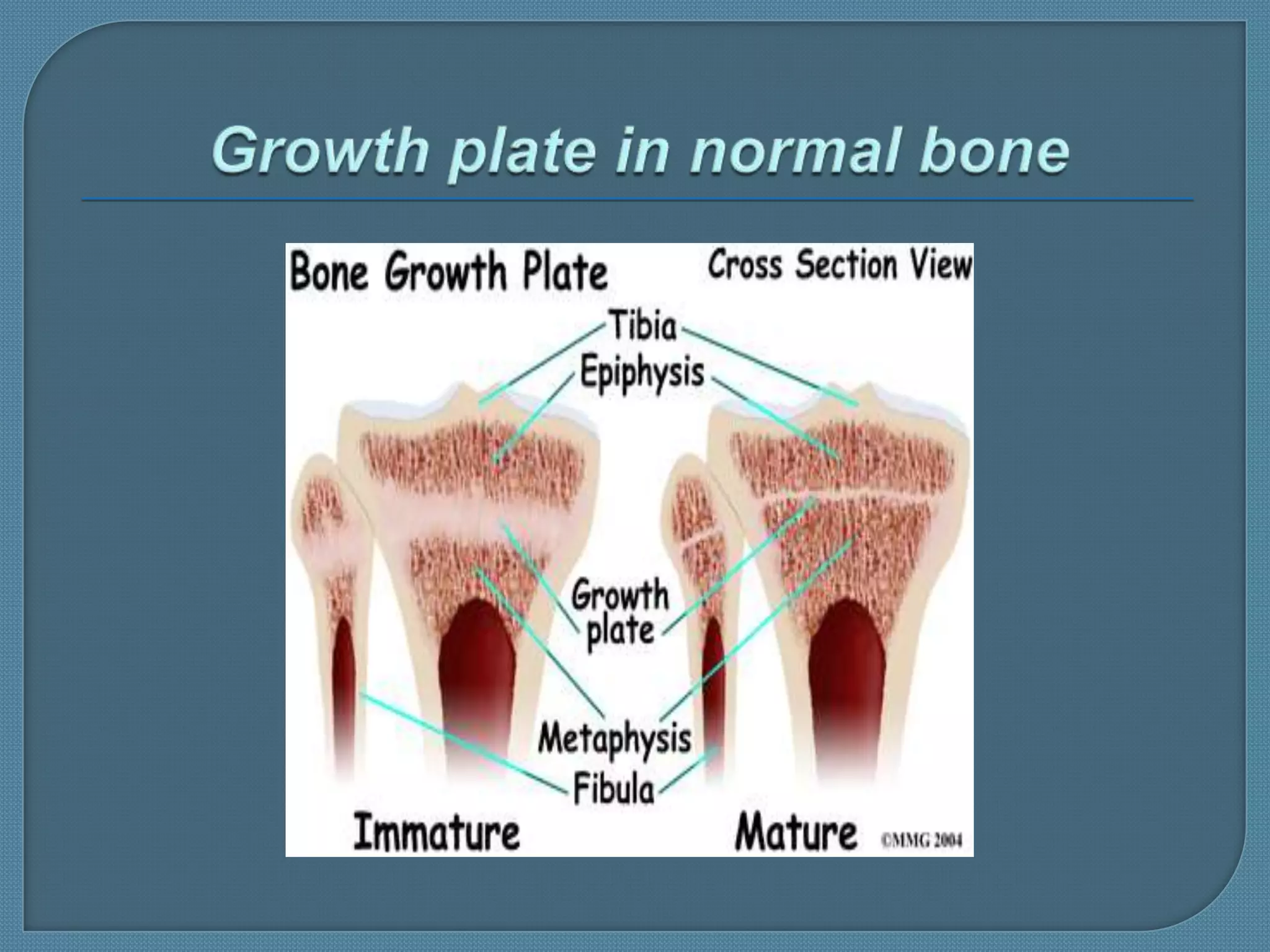 Rickets lecture | PPTX