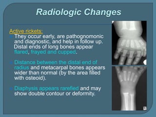 Rickets lecture | PPTX
