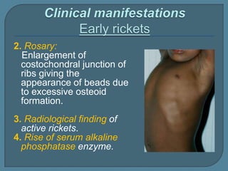 Rickets lecture | PPTX