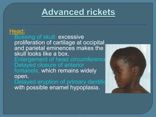 Rickets lecture | PPTX