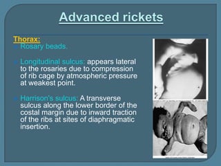 Rickets lecture | PPTX