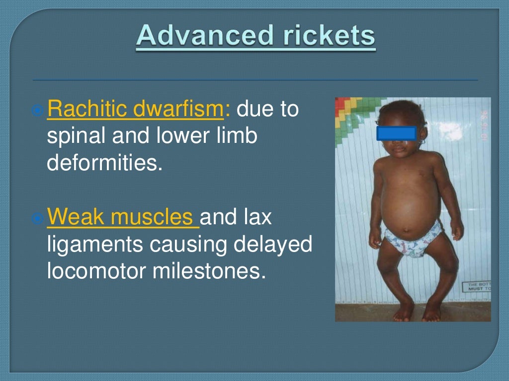 Rickets lecture