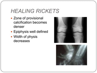 Rickets & Osteomalacia | PPTX | Bone and Joint Conditions | Diseases ...