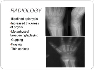 Rickets & Osteomalacia | PPTX | Bone and Joint Conditions | Diseases ...